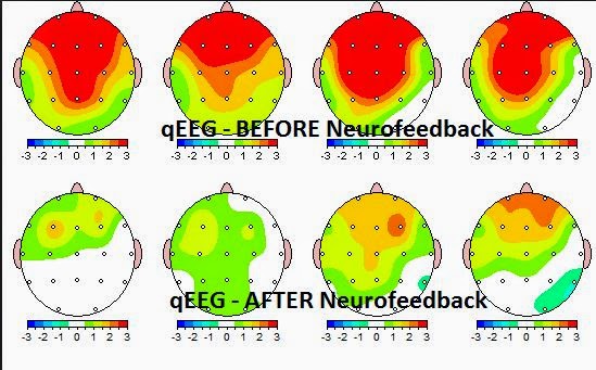 Neurofeedback - Peak Clarity Experiential Counseling & Neurofeedback
